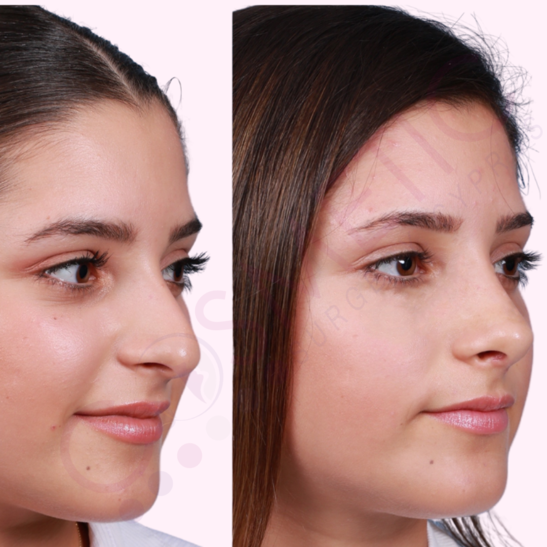 Ultrasonic Rhinoplasty Abroad Benefits - Cosmetic Surgery Abroad